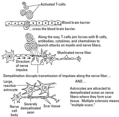Immune and Nervous Systems Roles in Multiple Sclerosis - dummies