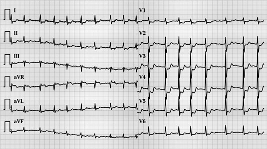 Cardiac Conduction Disorders Covered on the Physician Assistant Exam ...