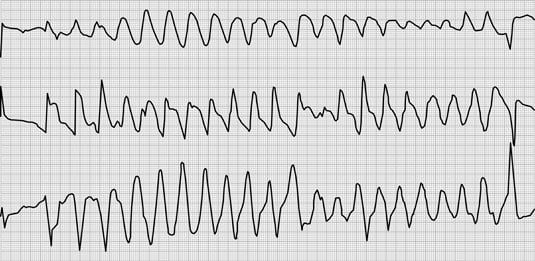 Types of Ventricular Arrhythmias to Know for the Physician Assistant ...