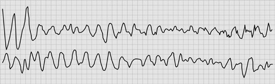 Types of Ventricular Arrhythmias to Know for the Physician Assistant ...